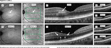Structure Of Outer Plexiform Layer Of Retina Semantic Scholar