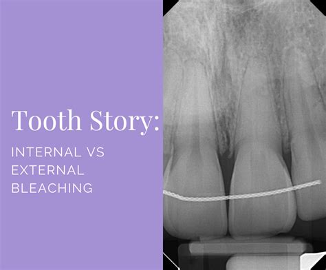 Internal And External Bleaching Of Teeth Protocols That Protect Teeth