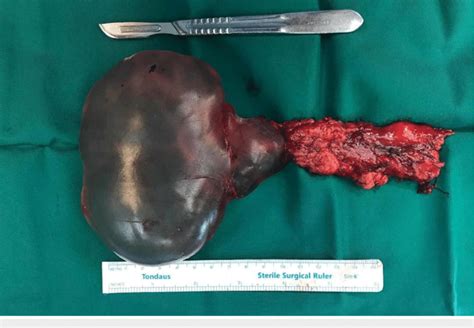 Surgical View Of The Thymic Cyst Download Scientific Diagram