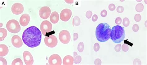 Educational Case Acute Promyelocytic Leukemia With Pml Rara Academic