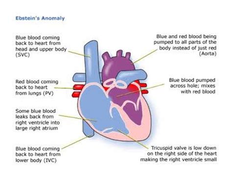 Ebsteins Anomaly Medizzy