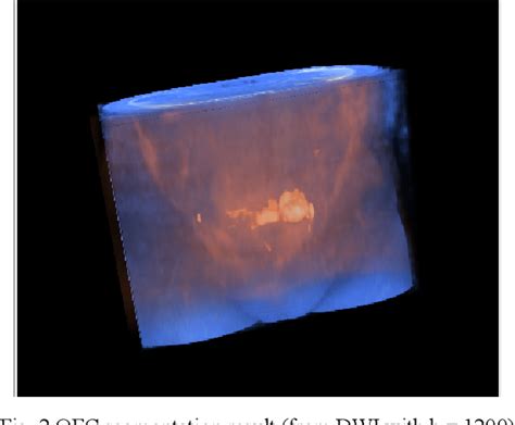 Figure 2 From Automated 3d Segmentation System For Detecting Tumor And