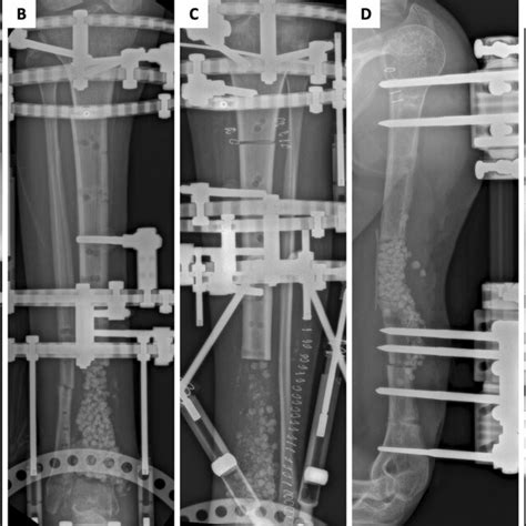 Distal Tibia Osteomyelitis In Patient 1 Ac Ap Radiographs Of The