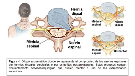 Cervicalgia Causas Y Tratamientos De Cervicalgia