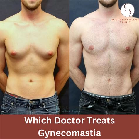 Male Gynecomastia Surgery Chirurgien Gynécomastie Ggwe