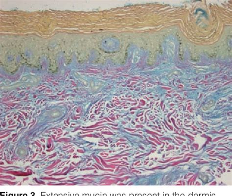 Ichthyosis Vulgaris Histology