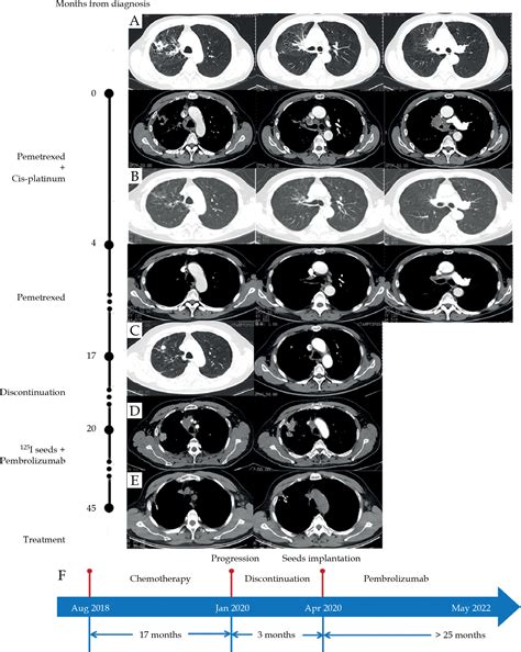Iodine 125 Seed Brachytherapy Combined With Pembrolizumab For Advanced