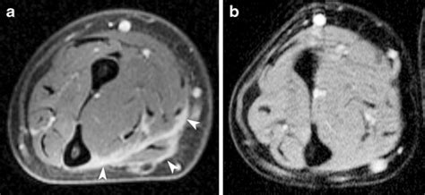 A 15 Year Old Girl With Linear Scleroderma Involving The Proximal Right