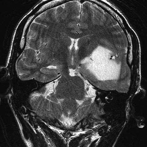 Radiopaedia Case Diffuse Astrocytoma NOS Id 10183 Study 10718 NC Commons