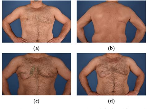 Figure 1 From Development Of A Surgical Treatment Algorithm For Breast Reconstruction In Poland