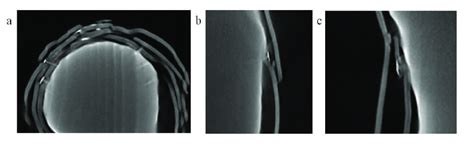 Details Of Fixing Nails In Tomograms A In Head B In Left Hip C