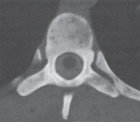 13 Generalized Bone Disease Radiology Key