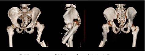 Figure 2 From Concurrent Ipsilateral Fractures Of Acetabular Posterior Wall And Femoral Shaft