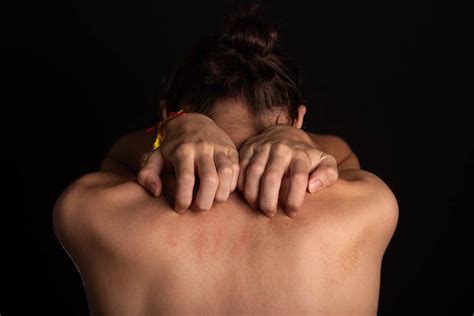 Can You Catch Shingles A Gp Explains What People Get Wrong About This