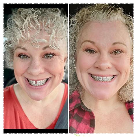 8 Month Progress Pics R Braces