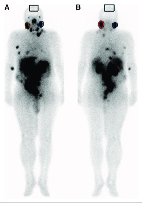 Region Of Interest Measurements On 177 Lu Psma 617 Uptake Anterior