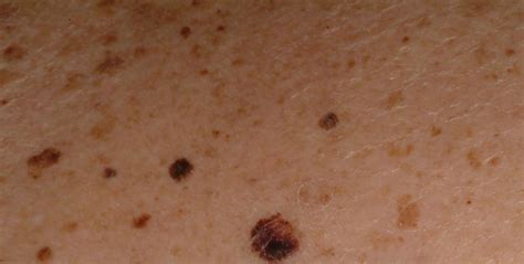 Skin Checks Four Reasons To Get Your Skin Checked Early And Regularly