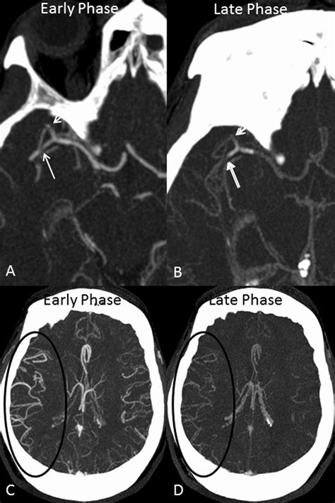 Calcified Embolus Mimics Patent Middle Cerebral Artery On Ct Angiogram