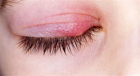 Blepharitis Liver Doctor
