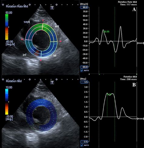 Example Of Assessment Of 2d Speckle Tracking Rotation Rate A And
