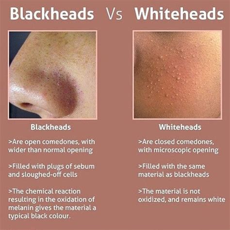 Whiteheads Vs Blackheads
