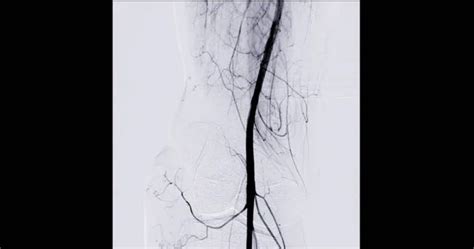 Femoral Angiogram Medical Procedure Used Visualize Blood Vessels Groin