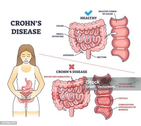 Crohns Disease As Inflammatory Bowel Problem Explanation Outline