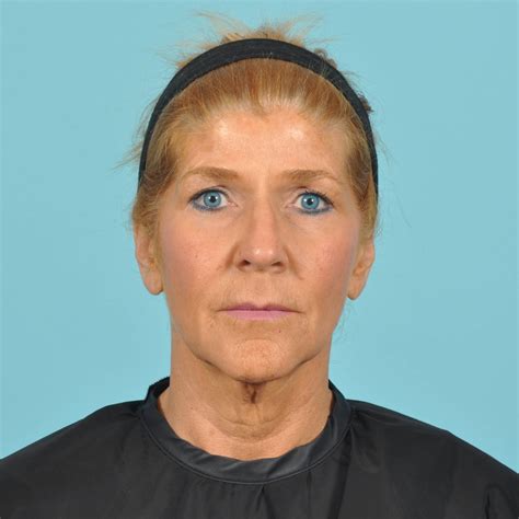 Blepharoplasty Before And After Photos Bengtson Center