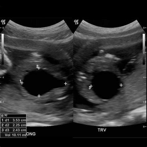 Pediatric Sonography Week 4 Flashcards Quizlet