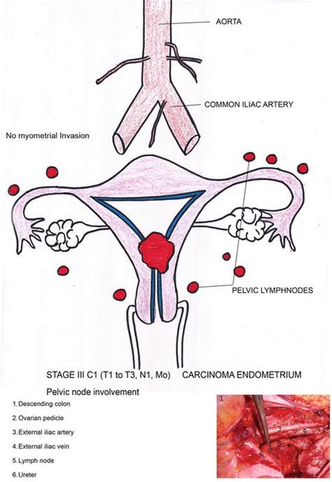 Endometrial Cancer Staging Obgyn Key