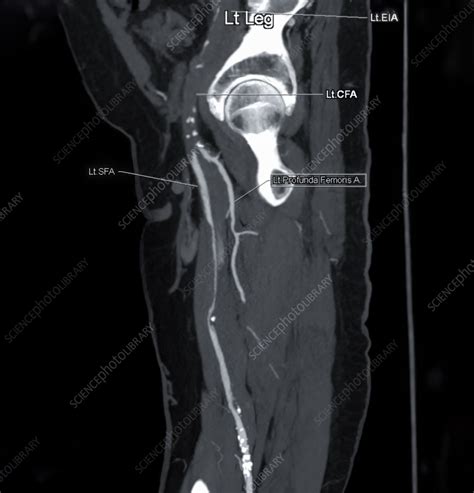 Thigh Arteries Ct Scan Stock Image F037 5813 Science Photo Library