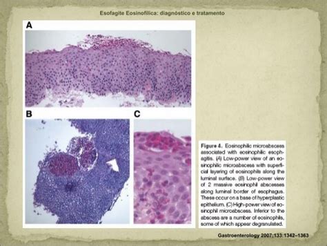 Esofagite Eosinofílica