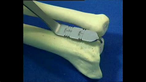 Uhp Ulnar Head Prosthesis Youtube