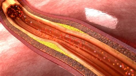 Descubren Una Droga Que Reduce Drásticamente Infartos Y Derrames