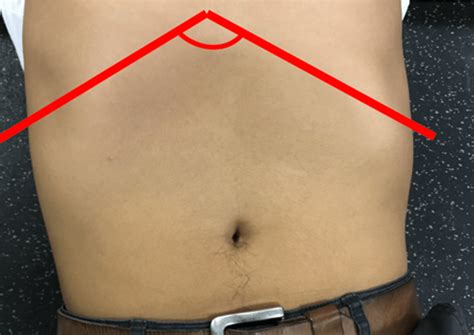 Infrasternal Angle Treatment 101