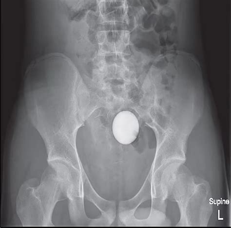 Teen Lands Bizarre Hole In One — In His Butt How Docs Got It Out