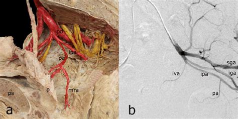 Type Iv Prostatic Artery Originating From The Internal Pudendal