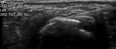 Ultrasound Guided Foot And Ankle Procedures Physical Medicine And