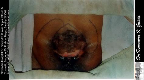 Devendras Technique Of Ectopia Vesicae Repair Without Pelvic Osteotomy