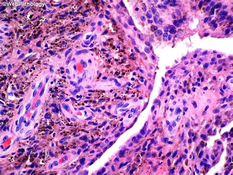Hemosiderotic Synovitis