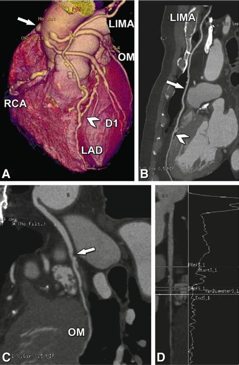 Coronary Artery Bypass Grafts Radiology Key