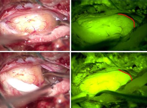 Plexiform Schwannoma Arising From Cauda Microsurgical Dissection With