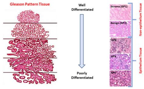 Multi Stage Classification Based Deep Learning For Gleason System