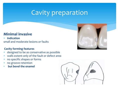 Class Iii Iv V Cavity Preparations For Composites Selvi Pptx