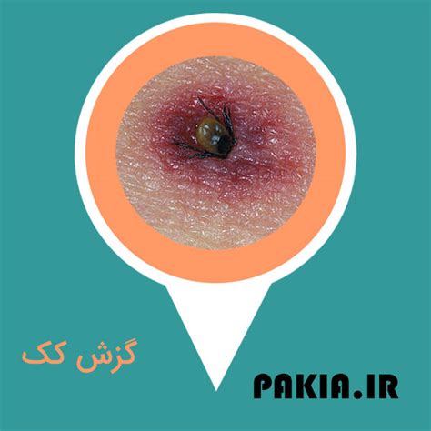 گزش کک و عوارض آن درمان سریع کک گزیدگی در خانه
