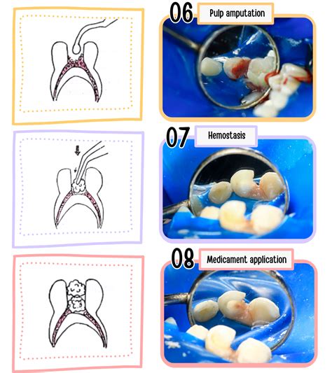 Pulpotomy Procedure Pediatric Dentistry Workbook