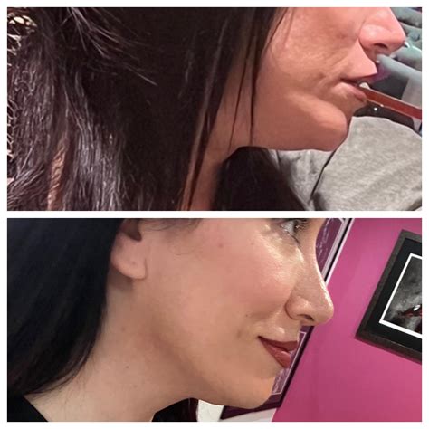 275 Best R Cosmeticsurgery Images On Pholder Turkey Rhinoplasty