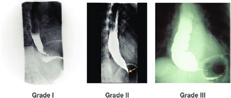 Upper Gastrointestinal Series Showing The Grade Classification Grade I Download Scientific