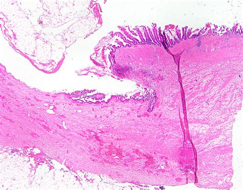 Pathology Outlines Lamn And Hamn