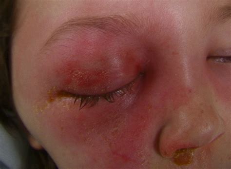 Cellulitis Under Eyelid